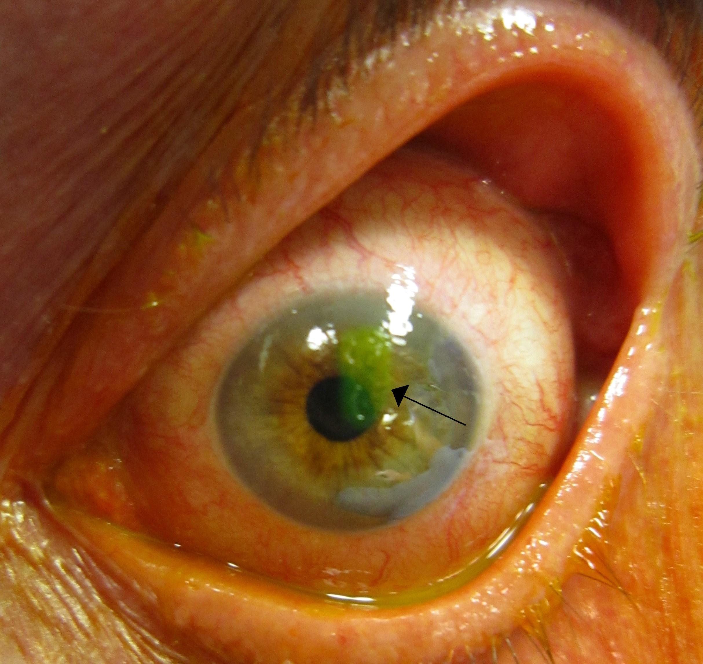 Recurrent Corneal Erosion RCE Canadian Association Of Optometrists Recurrent Corneal Erosion RCE Canadian Association Of Optometrists