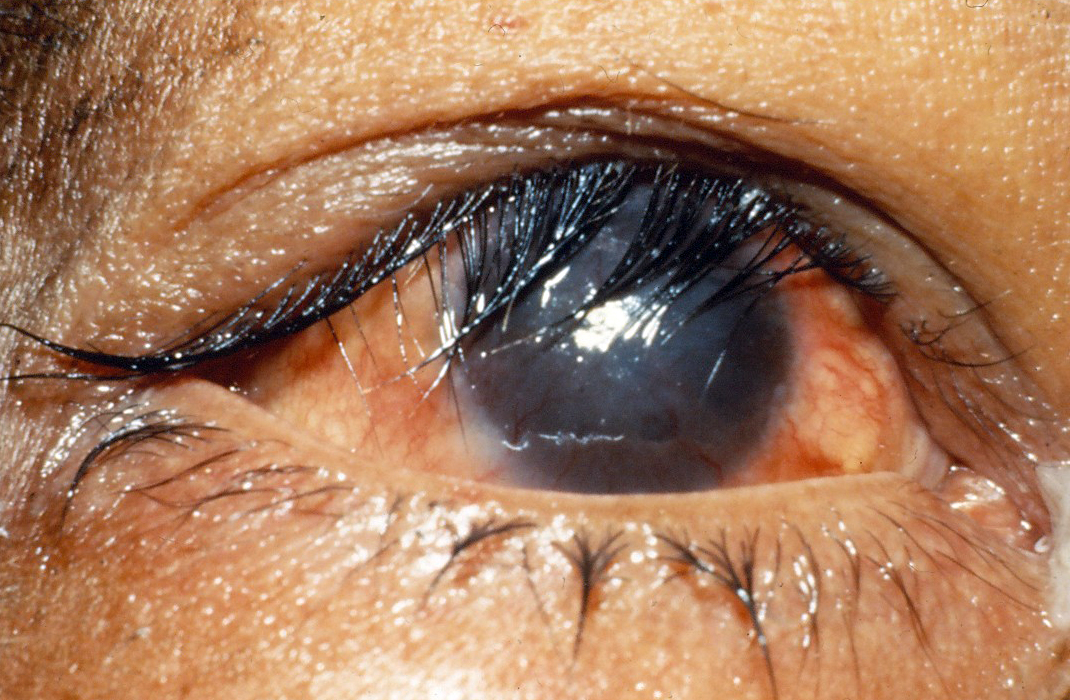 Trichiasis Canadian Association Of Optometrists Trichiasis Canadian Association Of Optometrists