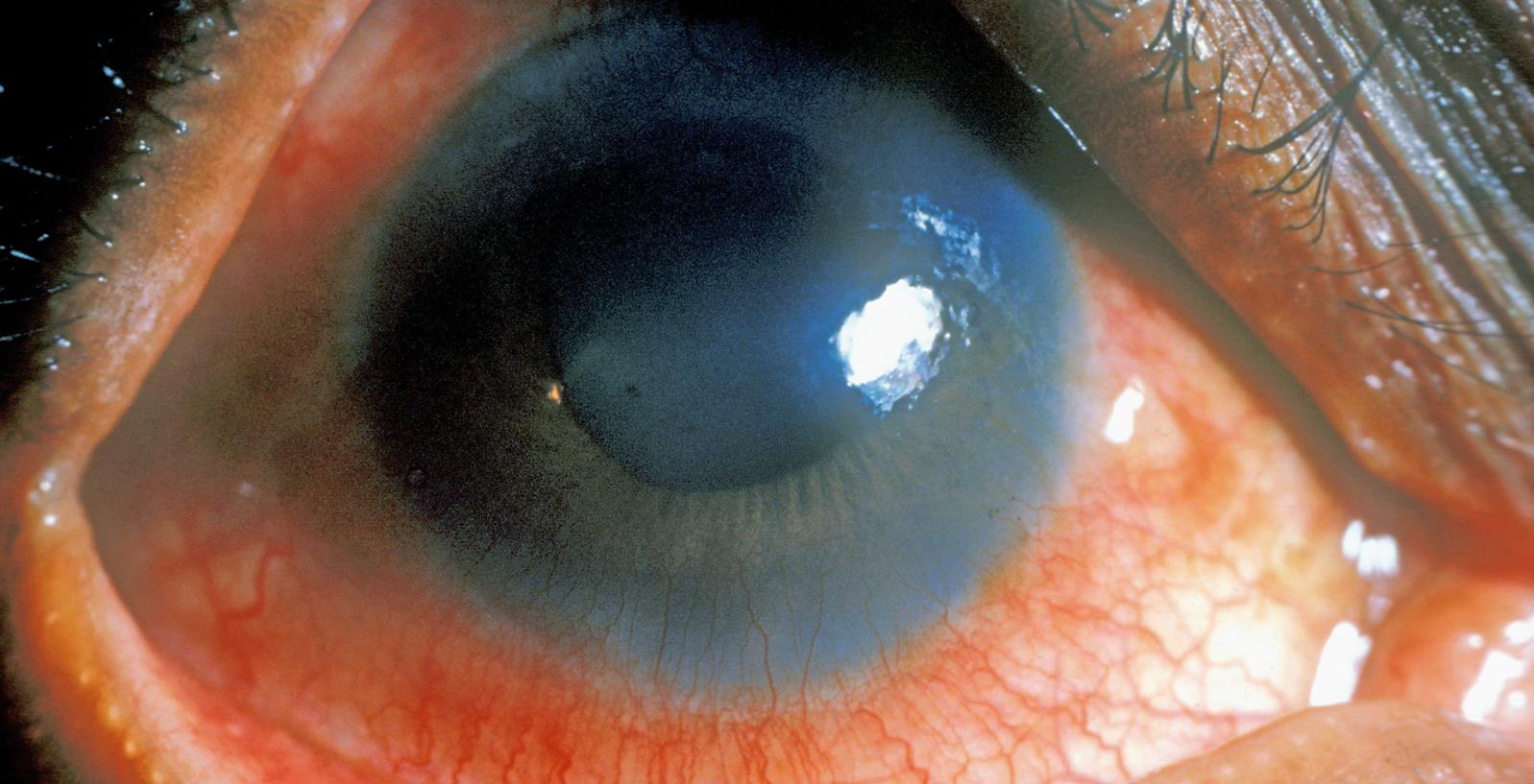 Uvéite antérieure | The Canadian Association of Optometrists