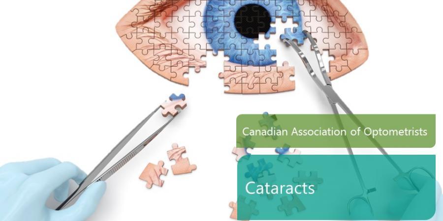 Cataracts | The Canadian Association of Optometrists